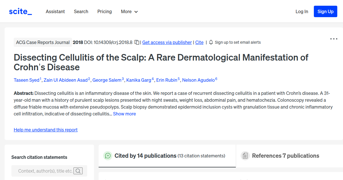 Dissecting Cellulitis Of The Scalp A Rare Dermatological Manifestation Of Crohnʼs Disease